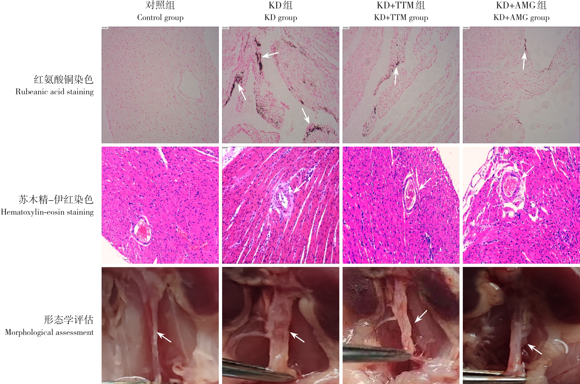 铜过载介导内质网应激在川崎病血管内皮损伤中的作用及机制研究